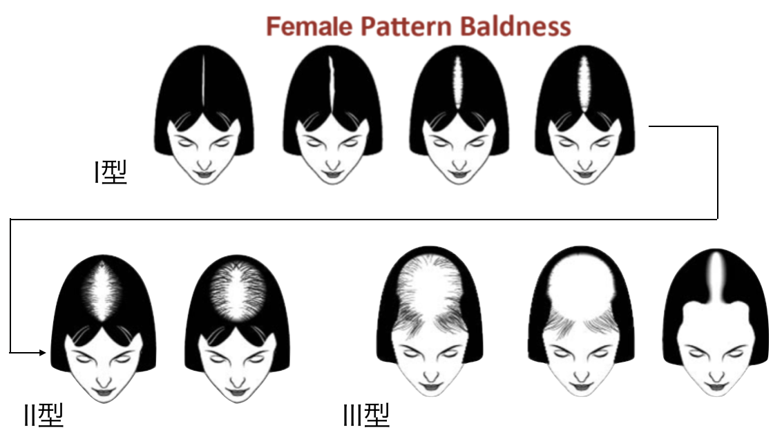 FAGAとは!?原因・症状・治療方法をやさしく解説